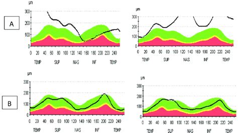 A Rnfl Examination Of Right And Left Eye In The First Examination B