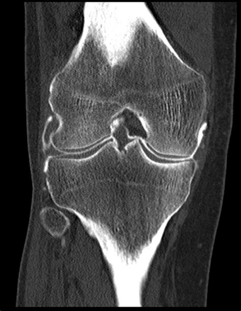 Arthrogram Pacs Arthrogram Pacs