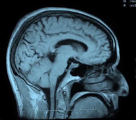 What Are Common Reasons For An Abnormal Ct Scan