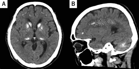 Intracranial Calcification Due To Hypoparathyroidism The American Journal Of Medicine Blog