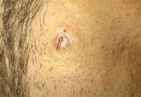 Epidermal Inclusion Cyst Photosepidermoid Cyst Archives New Pimple Popping Videos