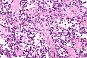 Rhabdomyosarcoma Libre Pathology