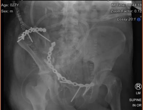 Fractured Right Acetabulum And Orif Of It R Xrayporn