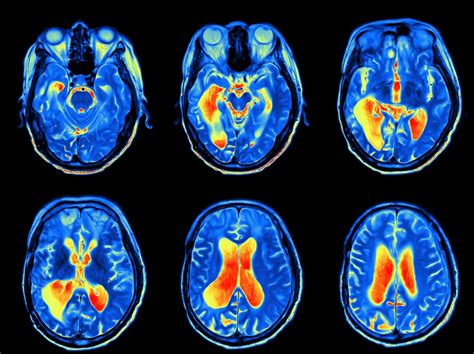 Guidelines For Using Fmri For Presurgical Evaluation Of Epilepsy
