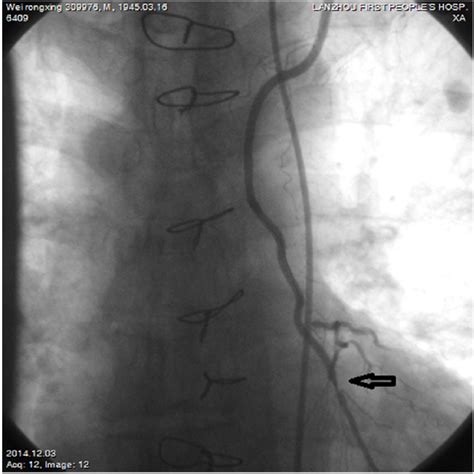 Angiography With Lima Showed 90 Stenosis Of Lad Download Scientific Diagram