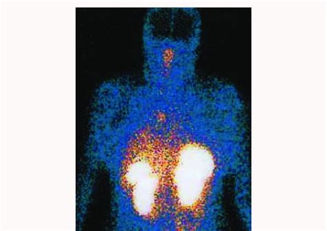 Octreotide Scan Which Showed Pathological Uptake In The Right Side Area Download Scientific