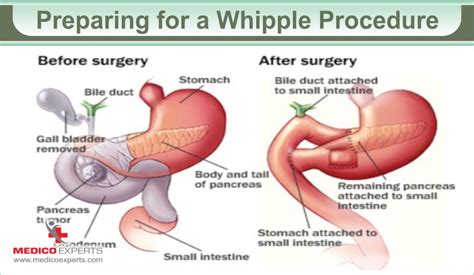What Is Whipple Procedure A Comprehensive Overview