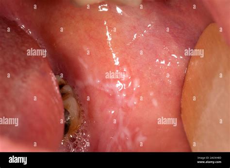 White Spots Inside Lips White Bumps On Lips Types Causes Symptoms