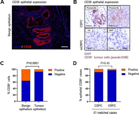 Cd38 Expression On Prostate Cancer Epithelial Cells And Benign