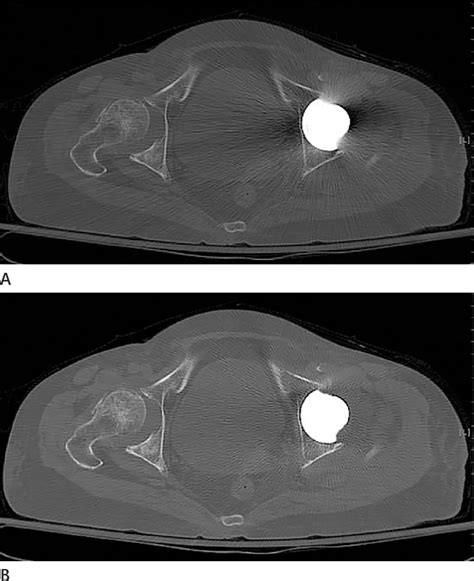 Figure 1 From Comparison Of Metal Artifact Reduction For Orthopedic Implants Versus Standard