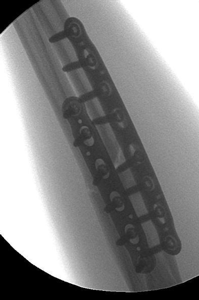 Radius Ulna Orif Expert Hand Surgeons In The East Bay