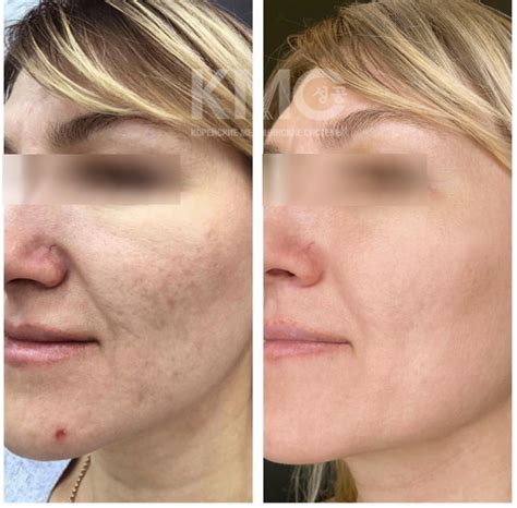 Eraser-C-RF - купить фракционный CO2 лазер для косметологии и ...