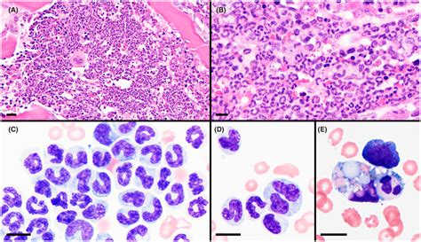 Bone Marrow Core Biopsy A And B And Aspirate C‐e Specimens Showing Download Scientific