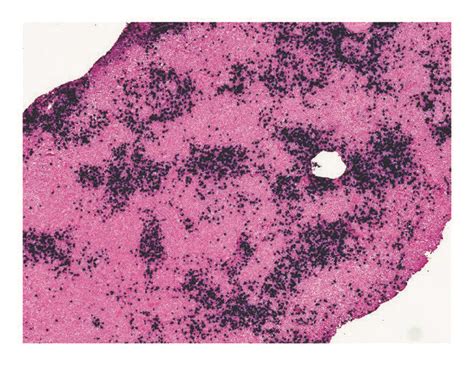 Kappa A And Lambda B Mrna By In Situ Hybridization Showing