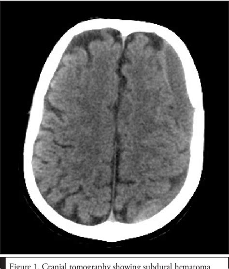 Figure 1 From Transient Facial Nerve Palsy After The Scalp Block For Burr Hole Evacuation Of