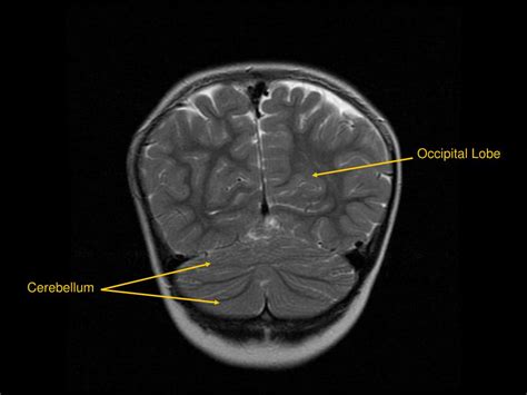 Ppt Mri Of Brain Head And Neck Powerpoint Presentation Free Download