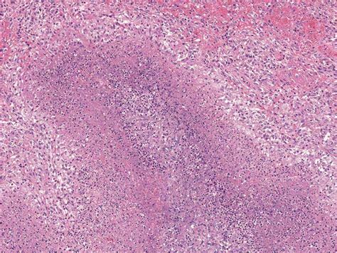 Aspergillus Histology