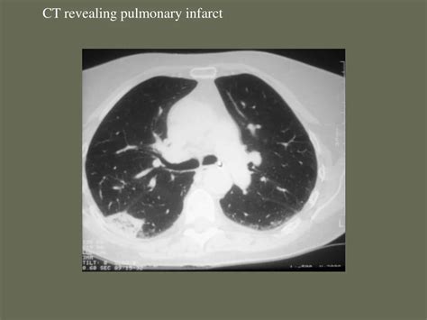 Ppt Pulmonary Embolism Powerpoint Presentation Free Download Id