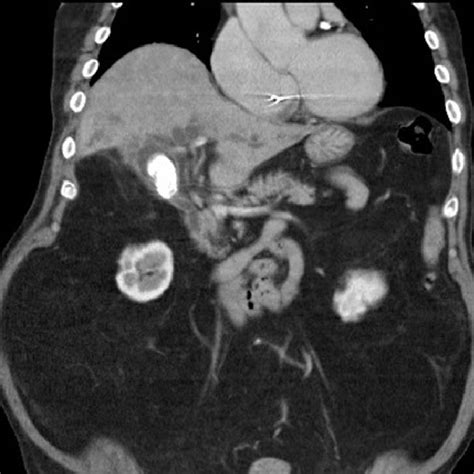 Cholangiogram Demonstrating Filling Defects At The Common Hepatic Duct Download Scientific