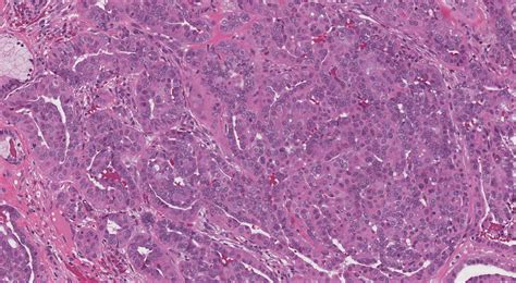 Your Pathology Report For Polymorphous Adenocarcinoma Mypathologyreport