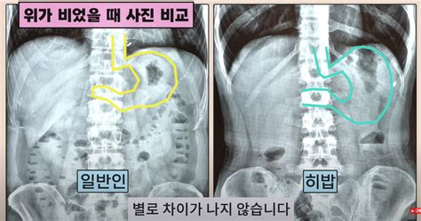 히밥 공복 Vs 식사후 위사진 짱공유닷컴 엽기유머