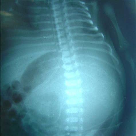 Pdf Immature Gastric Teratoma In A Newborn
