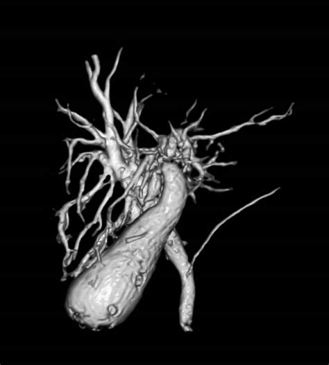 150 Fundus Of Gallbladder Foto Foto Stok Potret And Gambar Bebas Royalti Istock