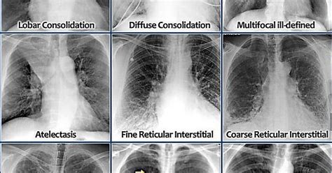 Cxr In Erpre A Ion Album On Imgur