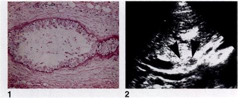 51 Year Old Man With Early Resectable Hilar Cholangiocarcinoma Download Scientific Diagram