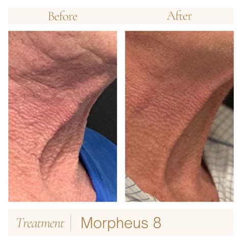 Morpheus8 Face Skin Rejuvenation Aspire Care Clinic Morpheus8 Face