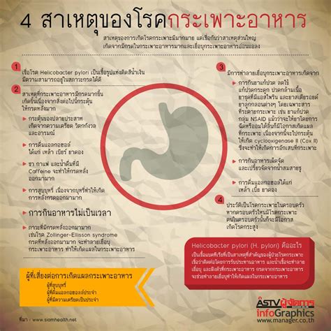 4 สาเหตุของโรคกระเพาะอาหาร