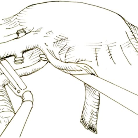 Single Incision Laparoscopic Donor Nephrectomy Port Placement A With Download Scientific