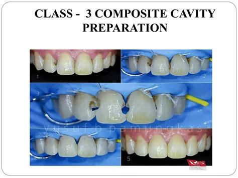 Class Iii Iv V Cavity Preparations For Composites Selvi Pptx