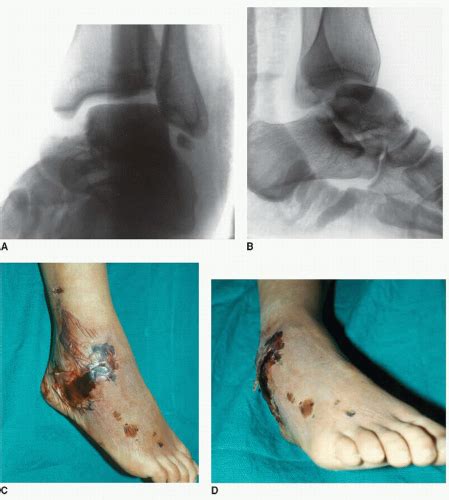Talus Fractures Open Reduction Internal Fixation Musculoskeletal Key