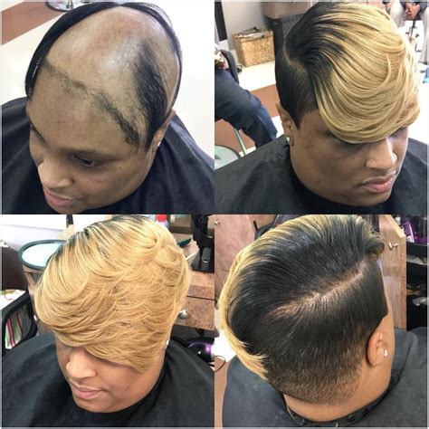 10 Alopecia Hairstyles Ideas Alopecia Hairstyles Traction Alopecia