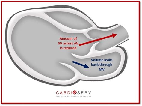 3 Steps To Quantifying Mr Via Stroke Volume Method Cardioserv