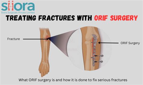 Treating Fractures With Orif Surgery Mindxmaster