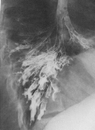 Bronchiectasis Flashcards Quizlet