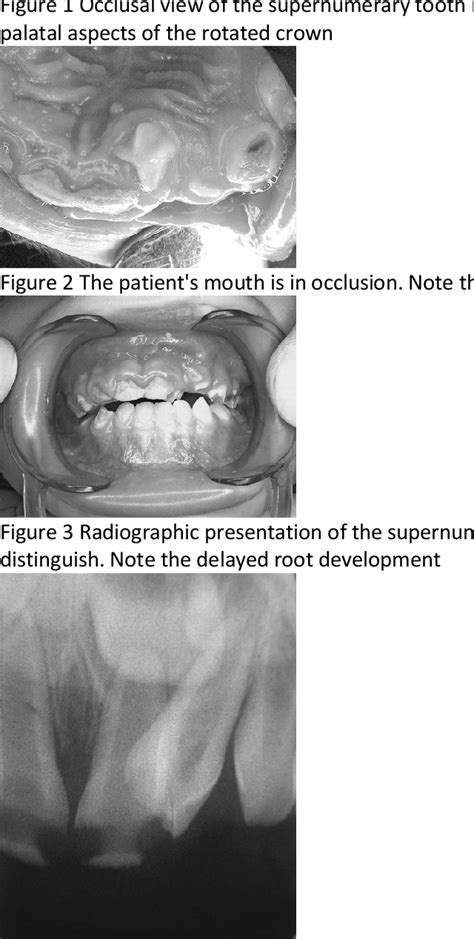 Figure 1 From Buccal And Palatal Talon Cusps With Pulp Extensions On A