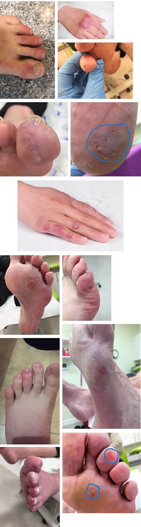 What Are Chilblains Lindsey Ebbs Podiatry