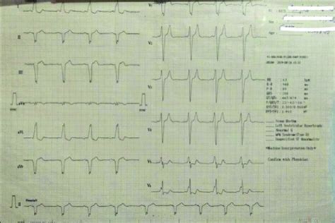 Pre Op Ecg Showing Wpw Pattern Download Scientific Diagram