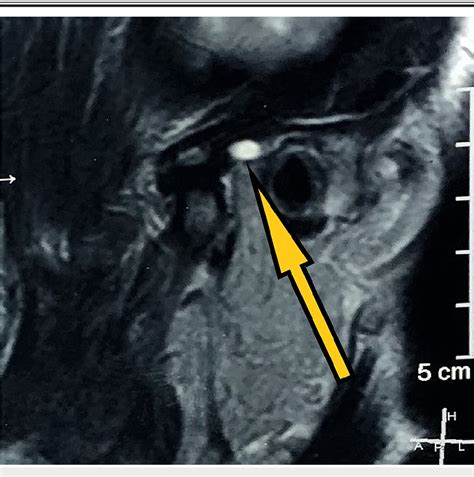 Figure 3 From Bifid Mandibular Condyle As The Hidden Cause For Temporomandibular Joint Disorder