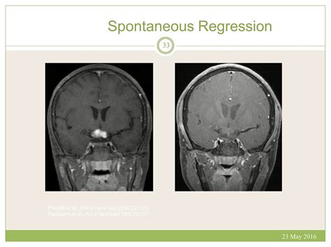 Optic Pathway Glioma Pptx