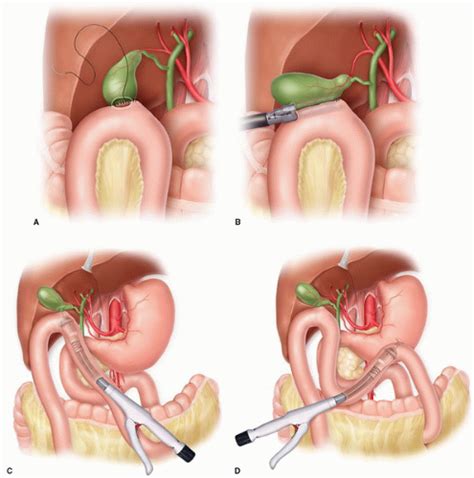 Operative Palliation Of Pancreatic Cancer Abdominal Key