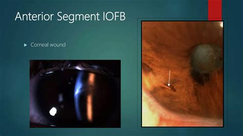 Intraocular Foreign Body Pptx