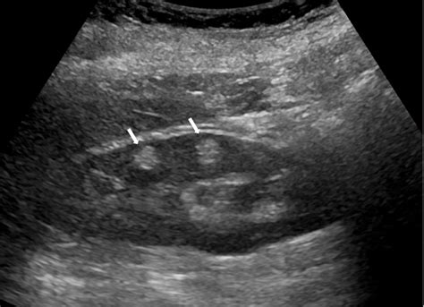 Angiomyolipoma Ultrasound