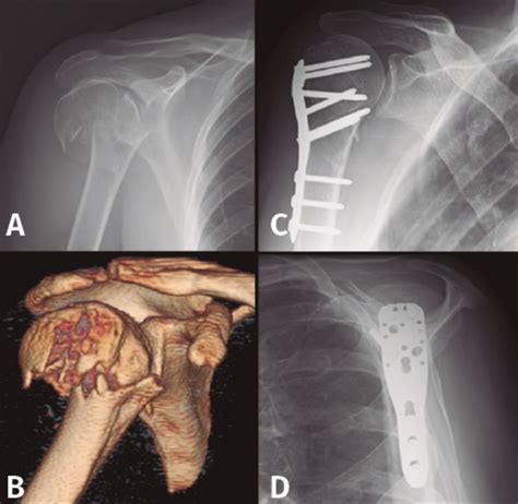 Dr Juan Luis Tomas Vidal On Linkedin Complex Proximal Humerus Fractures