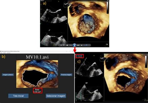 Mitral Valve Area Quantification Using Digital Image Processing Is