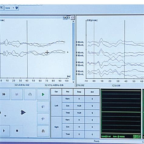 Auditory Brainstem Responses Of The Client Download Scientific Diagram