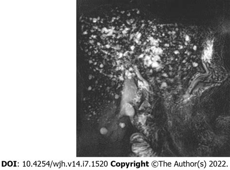 Gadolinium Contrast Enhanced Magnetic Resonance Cholangiography Download Scientific Diagram